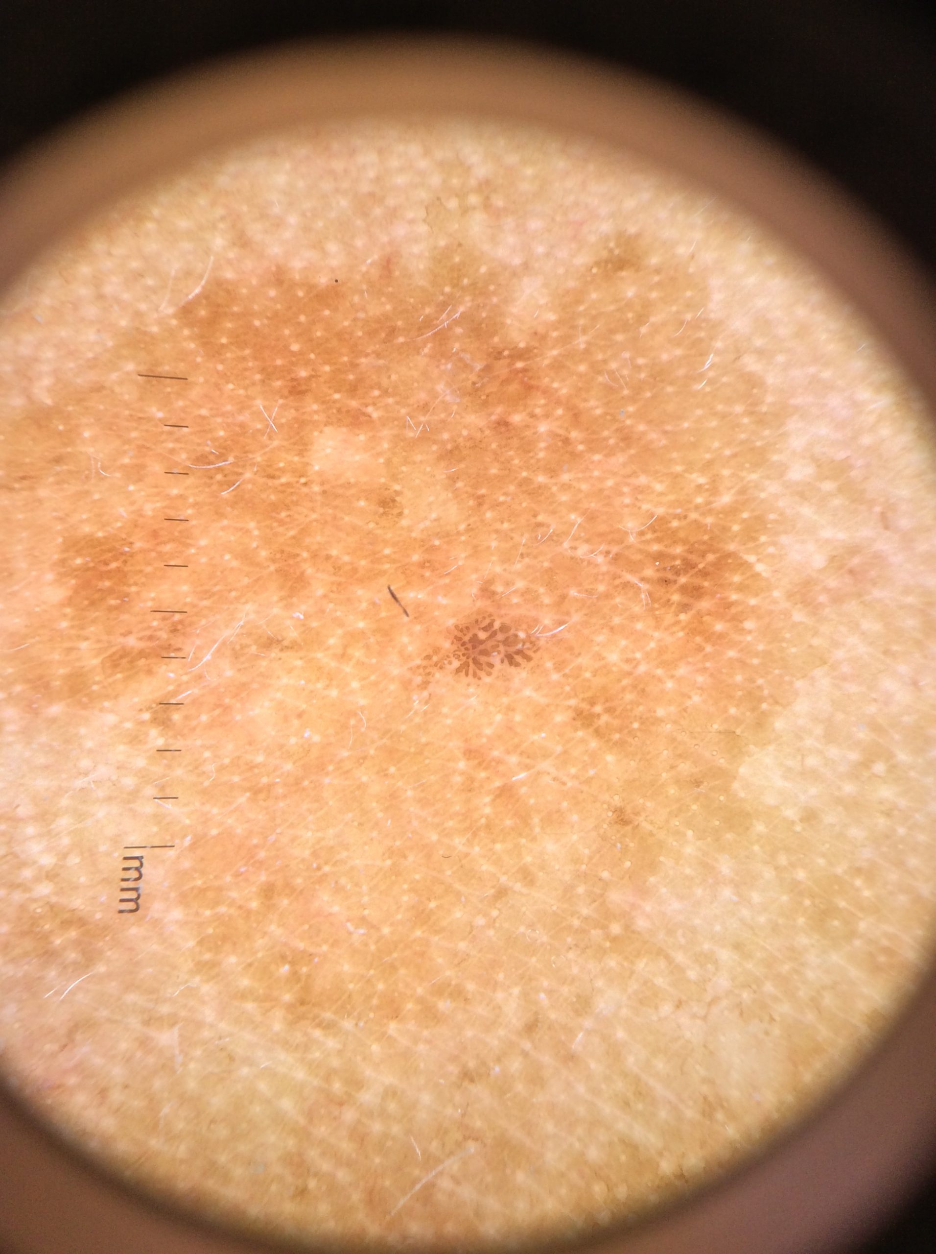 Macchie solari | Prevenzione, Diagnosi e Trattattamento | dott. Delmonte